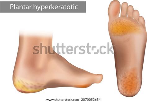 Palmoplantar Over 2 Royalty Free Licensable Stock Vectors And Vector Art Shutterstock