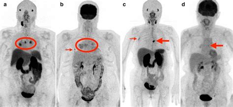 Patients With Metastatic Thyroid Cancer With Greater Psma Uptake Than Download Scientific