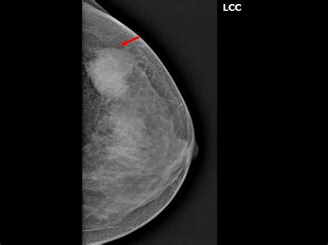 Atlas Of Breast Cancer Early Detection