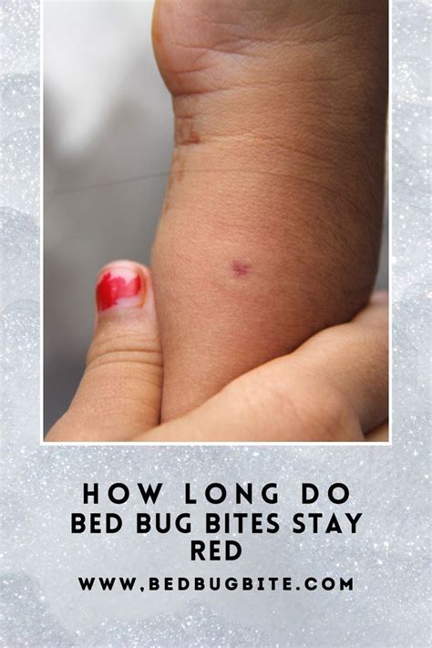How Long Do Bed Bug Bites Stay Red Bed Bug Bites Bed Bug Bites