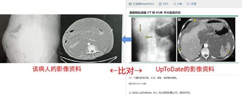 优秀临床案例｜一例罕见病例背后的思考：批判性思维和临床决策工具相结合，助力罕见病诊断 知乎