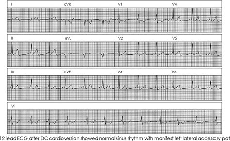 Figure 4 From Atrial Fibrillation With Ventricular Pre Excitation After