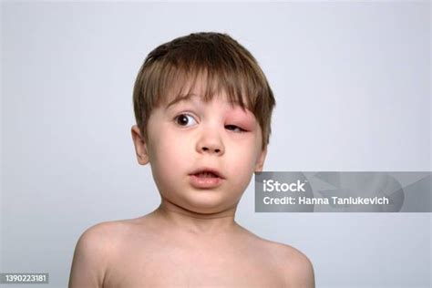 곤충 물린에서 빨간 부어 오른 눈을 가진 아이 Quincke 부종 불행한 백인 외모 소년의 초상화 고립 된 배경 알레르기 환자의 얼굴 공간을 복사합니다 스튜디오 알레르기