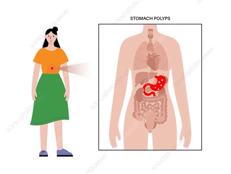 Stomach Polyps Illustration Stock Image F036 5565 Science Photo