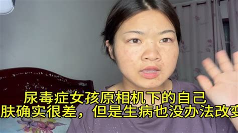 26岁尿毒症晚期女孩记录原相机下真实的自己，皮肤确实很差，但是生病没办法改变，怎么样才能控制住自己挤痘痘呢，脸都破皮了 Youtube