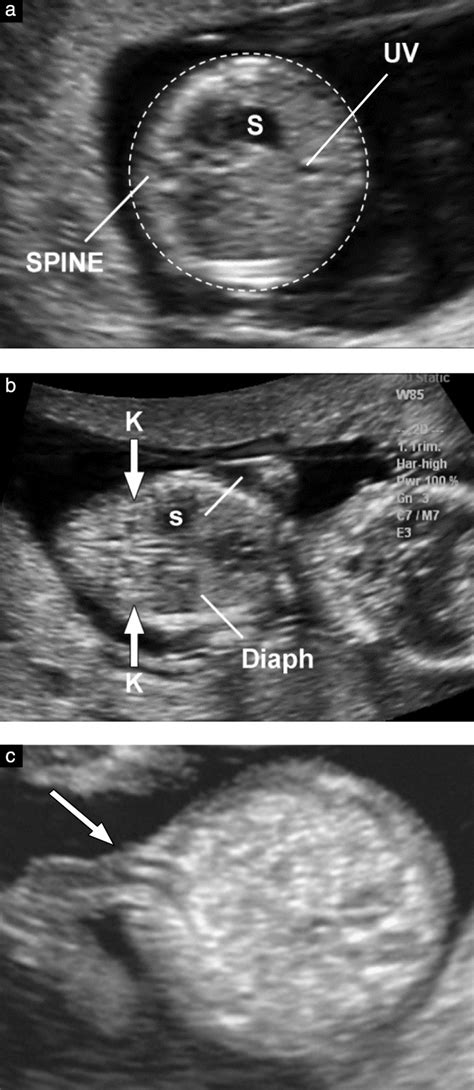 Isuog Practice Guidelines Performance Of First‐trimester 42 Off
