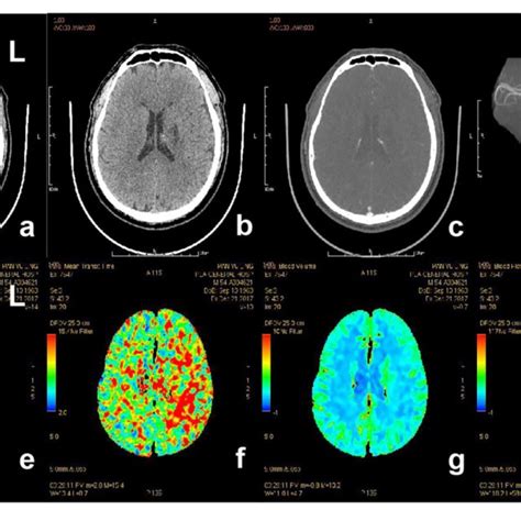 Ct And Ctp Imaging Of The Patient With Acute Ischemic Stroke The