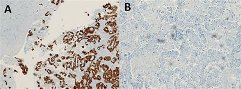 Pathology Slides With Immunohistochemistry And Markers Used In Unknown