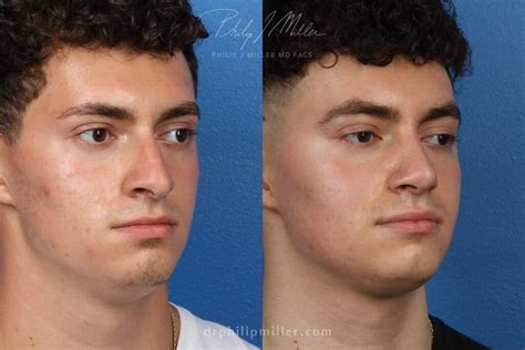 When To Choose A Nose Tip Surgery Over Full Rhinoplasty Philip