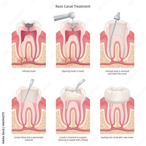 Root Canal Treatment Tooth Canal Rooth Filling Endodontic Procedure