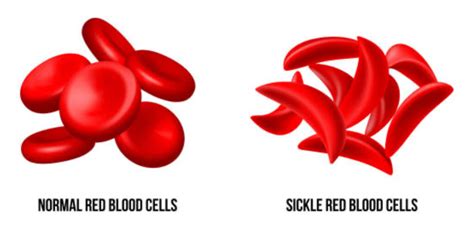 Facts About Sickle Cell Disease Sickle Gene International Foundation