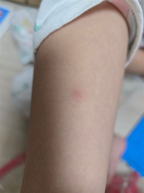 아이 몸에 벌레 물린것 같이 모가 났는데 이거 뭔가요 지식in