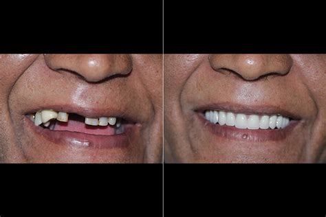 Cosmetic Dentistry In Mumbai India By Dentzz Dental Clinic Dentzz Dental