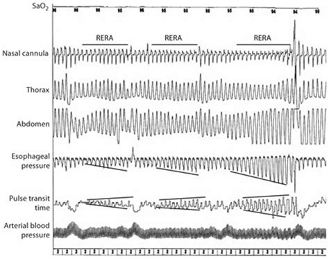 Upper Airway Resistance Syndrome Definition Causes Signs Symptoms