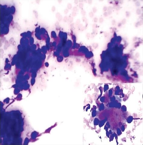 Nests Of Basaloid Cells Containing Basal Lamina Like Material In