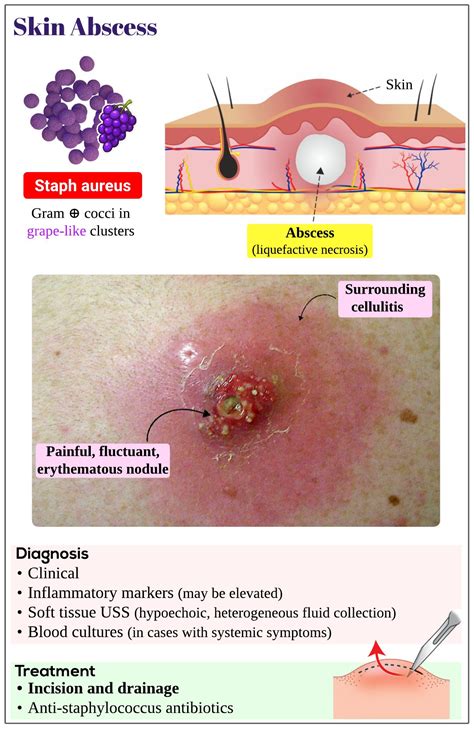 Skin Abscess Medicine Keys For MRCPs