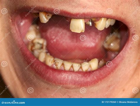 Dental X Ray With Periodontitis Problems Stock Image Cartoondealer