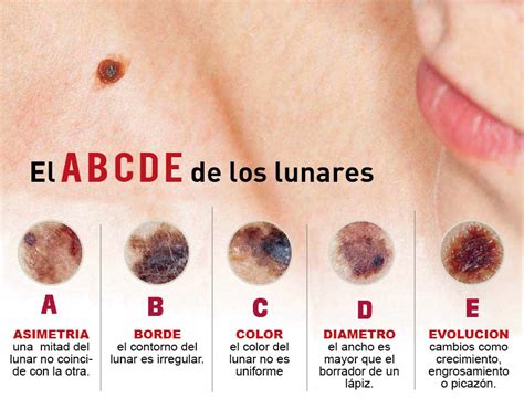 Controles Sin Turnos Y Gratuitos Semana De La PrevenciÓn Del CÁncer De Piel Funes Hoy