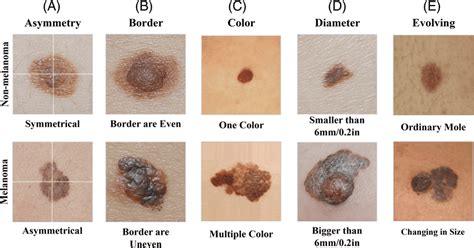 Why You Need To Keep An Eye On Your Skin And Get Regular Skin Checks
