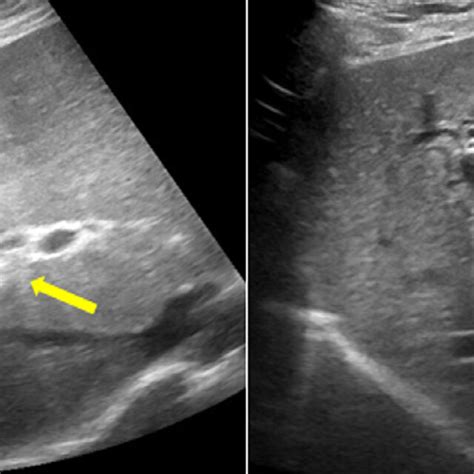 Hepatic Ultrasound Images In B Mode Showing The Presence Of