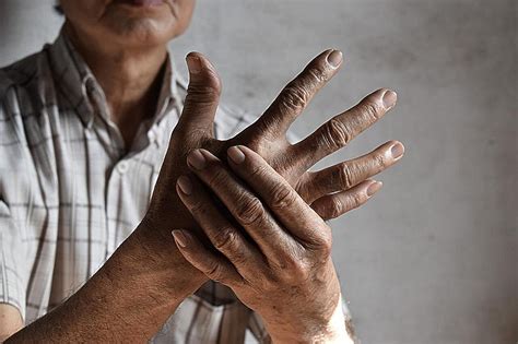 Rheumatoid Arthritis Causally Linked To Prostate Cancer