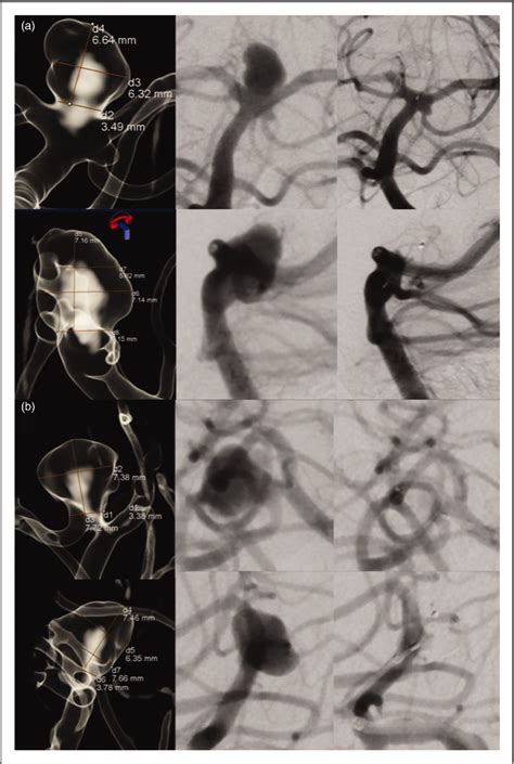 Table 1 From Semi Automated Cerebral Aneurysm Segmentation And Geometric Analysis For Web Sizing