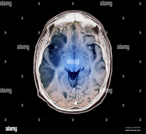 Stroke Coloured Axial Magnetic Resonance Imaging Mri Scan Through