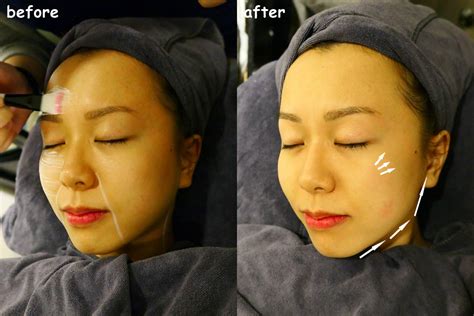 【美容院】imh Beauty Liftera V隔空無針埋線療程 Katerina的花俏部落格 •beauty •fashion
