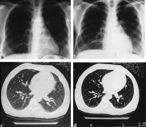 Patient 7 A Chest X Ray At Baseline Increased Interstitial Markings