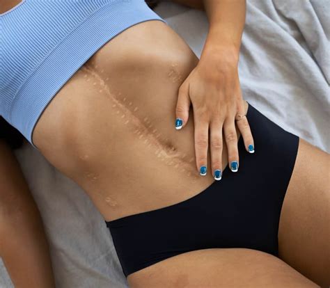 Remover Queloides Oasis Healing Spa