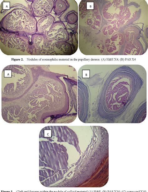 Figure 2 From A Rare Presentation Of Colloid Milium Semantic Scholar