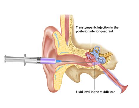 In Office Intra Tympanic Steroid Therapy Melbourne Ent Group Meg