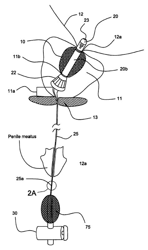 Prostatic Stent With Localized Tissue Engaging Anchoring Means And Methods For Inhibiting