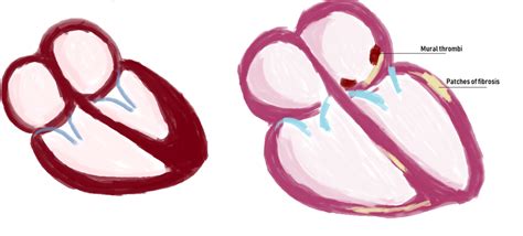 Dilated Cardiomyopathy The Fatality Of An Over Expanded Heart