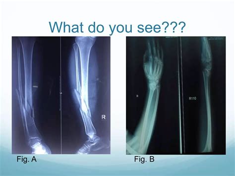 Fracture Classification And Healing Pptx