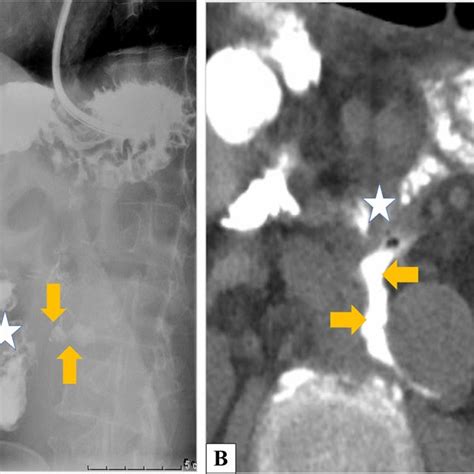 41 Year Old Woman With Erosive Antral Gastritis Supine Oblique Spot
