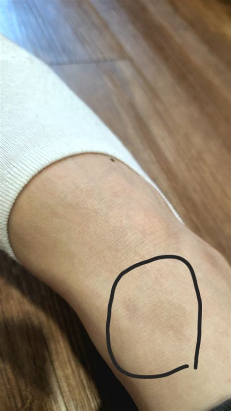 발목에 이상한 멍 처럼 생긴게 생겼어요 지식in