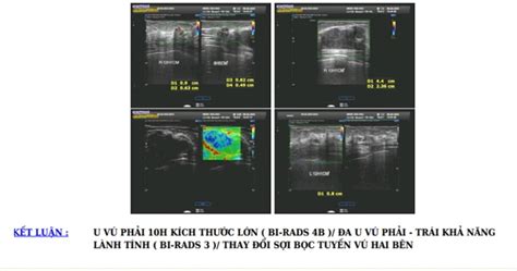 Vietnamese Medic Ultrasound Case 756 Phyllodes Tumor Dr Phan Thanh