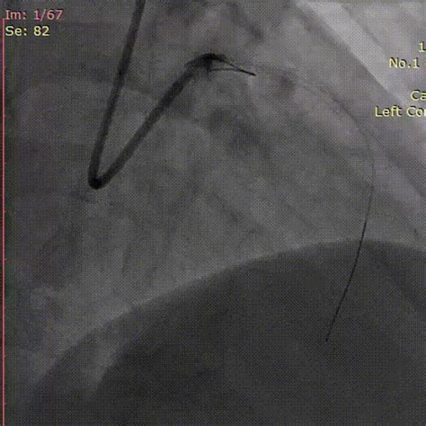病例荟萃第三十六期｜王乐：telescope™导引延长导管简化器械输送 严道医声网