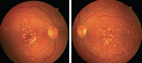the role of the complement pathway in amd modern optometry