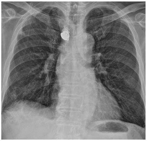 Subclavian Artery Pseudoaneurysm Following Bedside Temporary