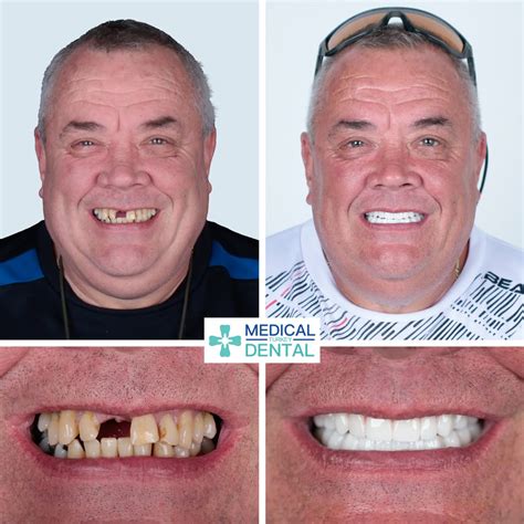 Front Tooth Dental Implants Antalya Turkey Cost Before And After