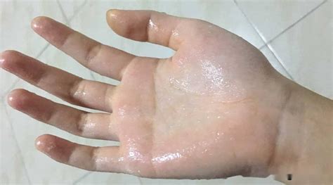 稍微一紧张就出手汗、脚汗？沈医生教你辨证分析，固摄止汗 知乎