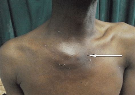 Fluctuating Swelling Of The Right Sternoclavicular Joint Which Has