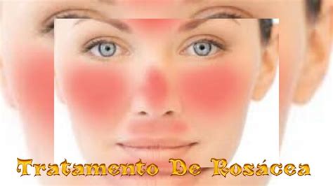 Tratamento De Rosácea Youtube