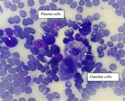 Gauchers Disease Lab Findings At Mitchell Dorgan Blog