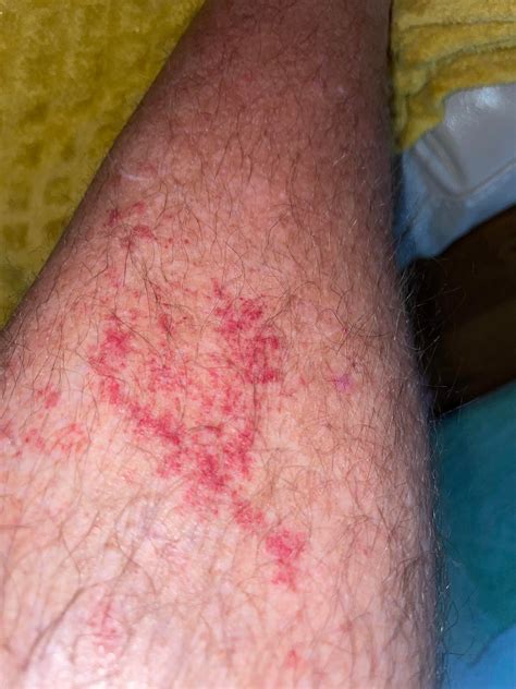 Rash On Leg Please Help Me Any Ideas R Dermatologyquestions