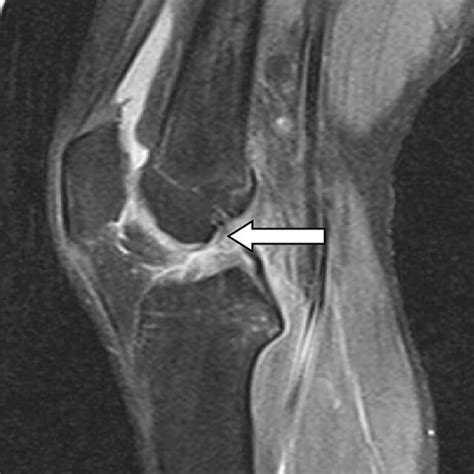 5 An Mri Image Showing Complete Disruption Of The Acl Download