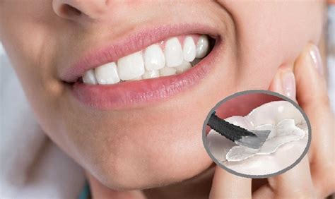 NguyÊn NhÂn VÀ CÁch KhẮc PhỤc TÌnh TrẠng TrÁm RĂng BỊ NhỨc