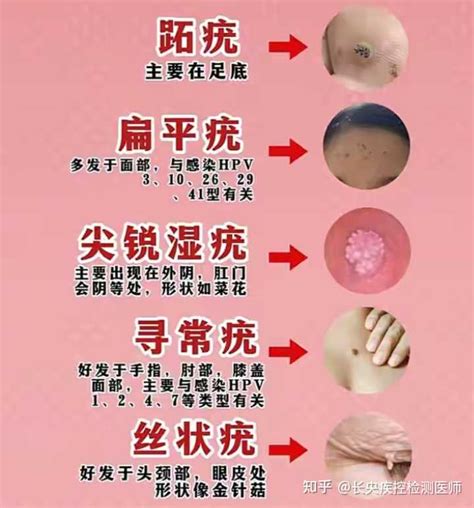 这是尖锐湿疣吗？这是？ 知乎